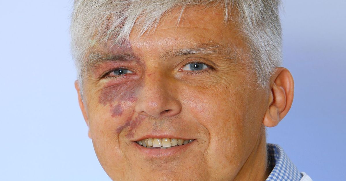 Neuer Ansatz in der Migräneprävention: Studie zeigt Wirksamkeit